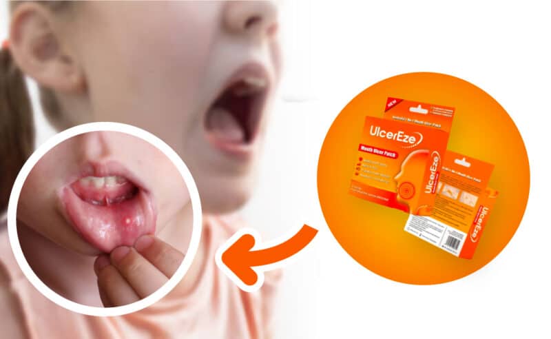 Mouth Ulcers in Children | UlcerEze Blog
