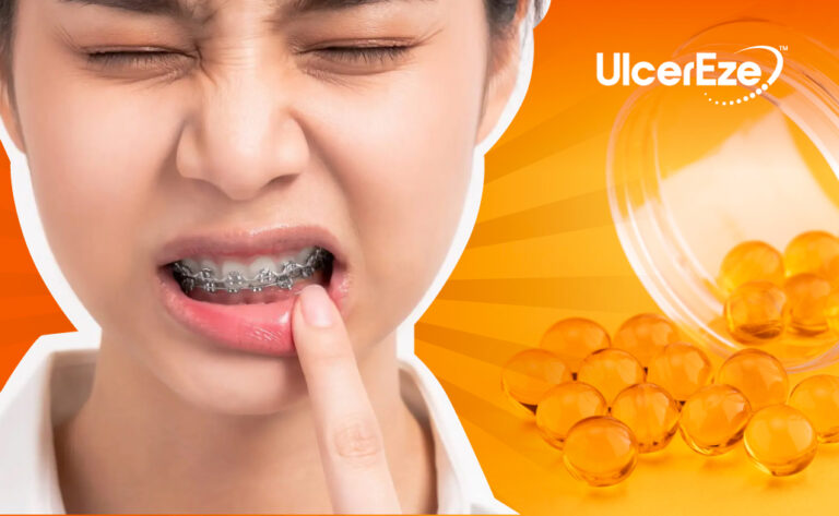 Mouth Ulcer Patch & Ulcer Treatment | UlcerEze